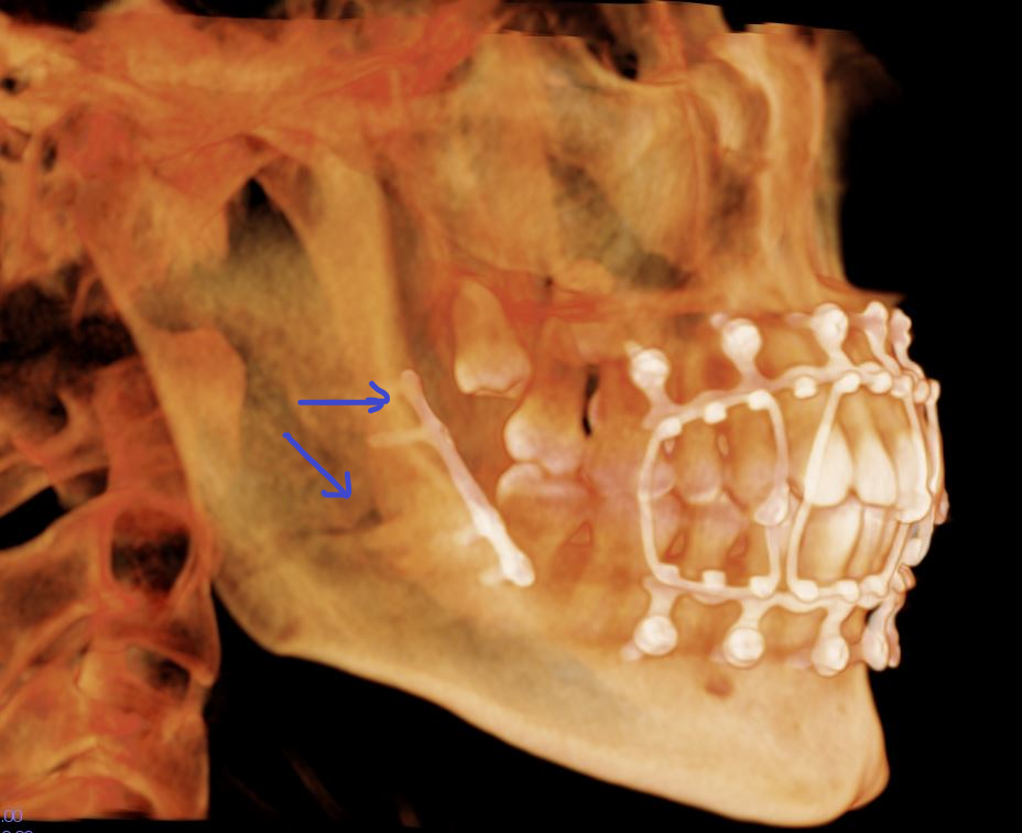 Mandible (Lower Jaw) Fractures Rancho Santa Margarita CA, Orange County ...