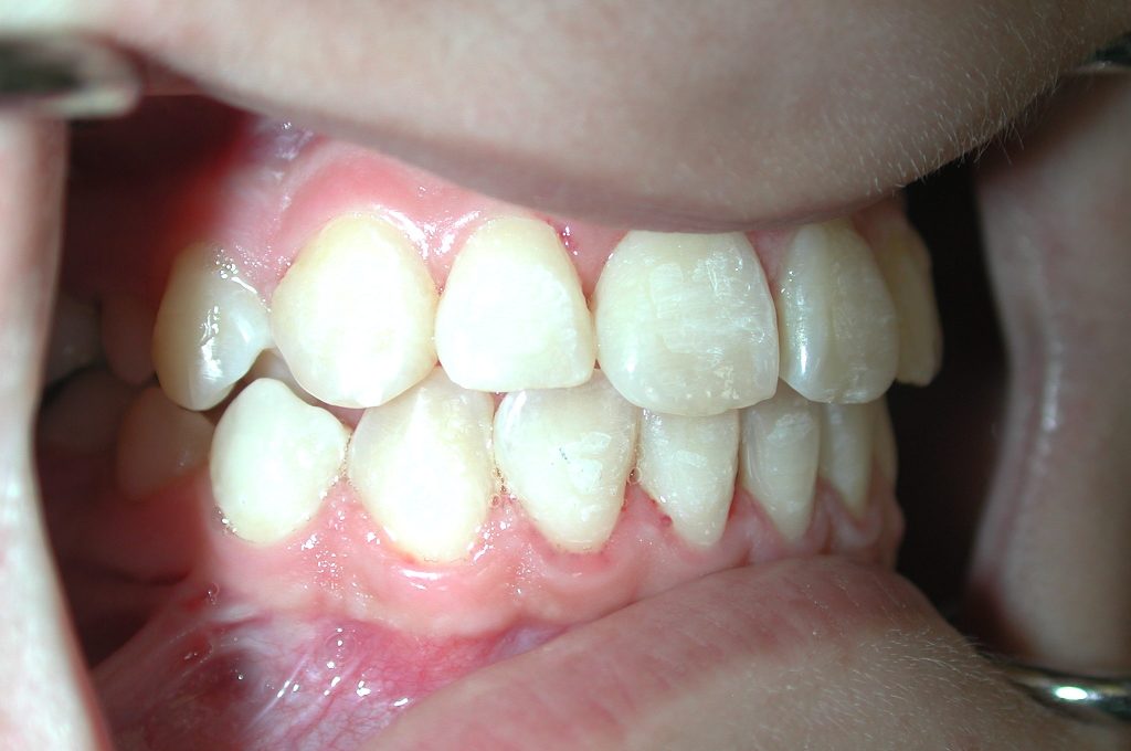 Upper Maxilla Surgery Rancho Santa Margarita Ca Orange County Surgical Specialists