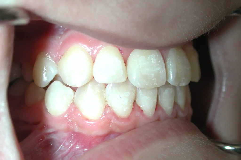 Upper Maxilla Surgery Rancho Santa Margarita Ca Orange County Surgical Specialists