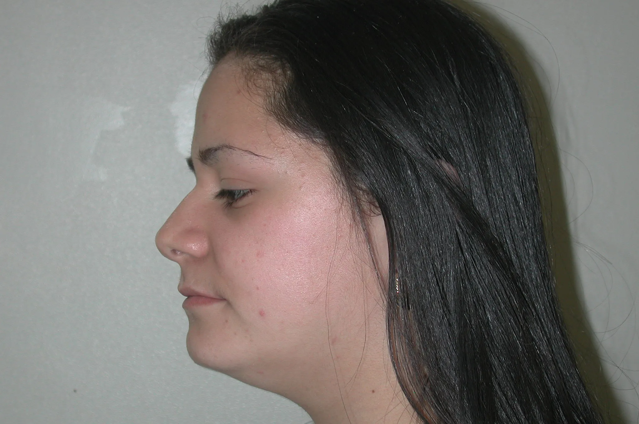 Upper (Maxilla) Surgery Rancho Santa Margarita CA, Orange County Oral ...