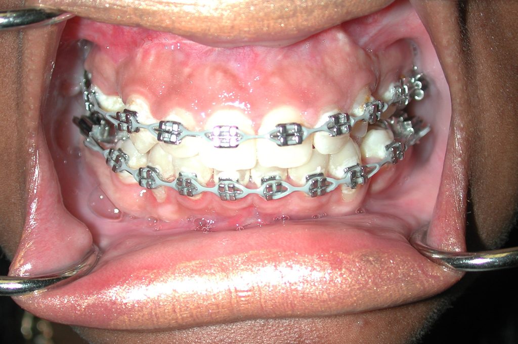 Upper (Maxilla) Surgery Rancho Santa Margarita CA, Orange County Oral ...