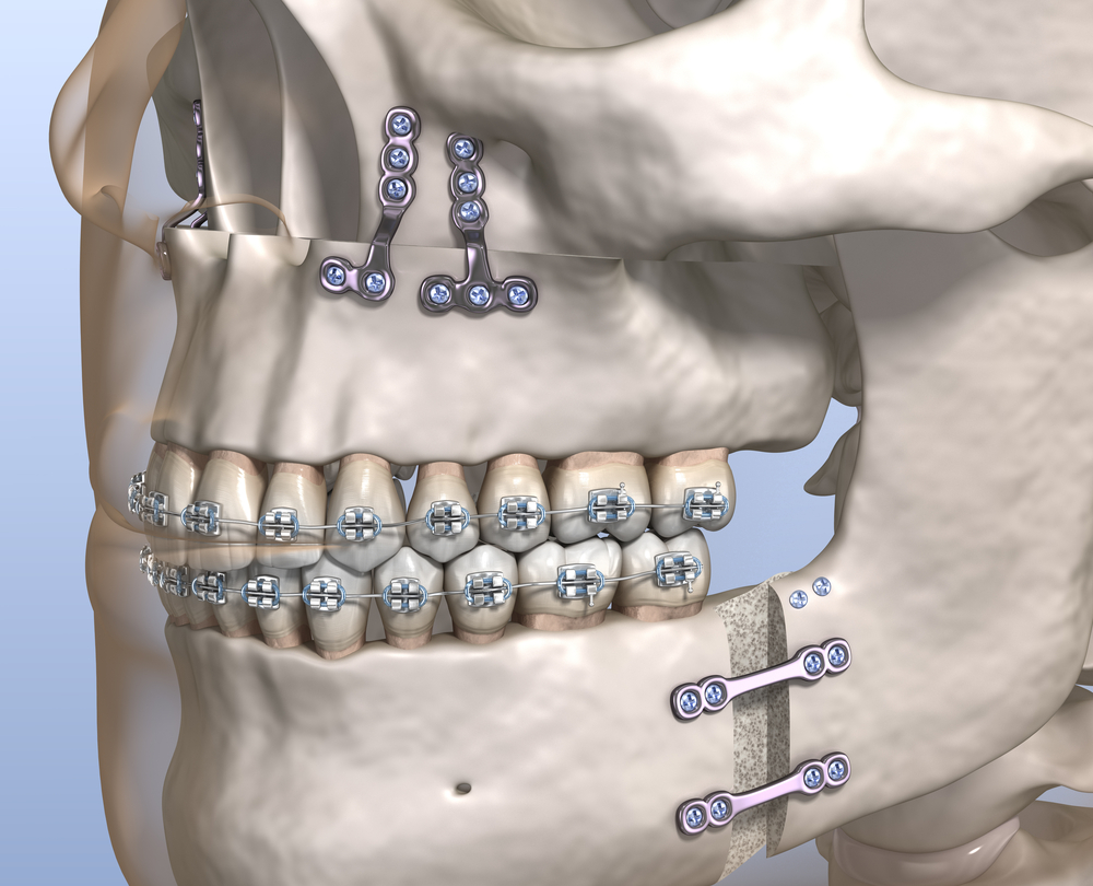 Upper (Maxilla) Surgery Rancho Santa Margarita CA, Orange County Oral ...