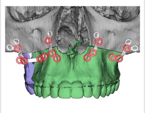 Upper (Maxilla) Surgery Rancho Santa Margarita CA, Orange County Oral ...
