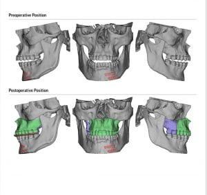 Upper (Maxilla) Surgery Rancho Santa Margarita CA, Orange County Oral ...